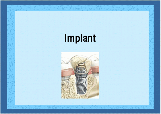 Implant(임플란트)에 대해