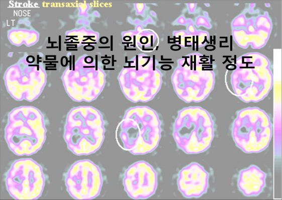 뇌졸중 전반조사 (해부/병태생리/약물/치료개발동향).ppt