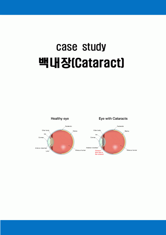 백내장(Cataract) 케이스 스터디 A+ - (백내장 케이스 스터디, 백내장 간호과정, 백내장 간호진단, 안과 실습, CATARACT CASE STUDY, 백내장 CASE STUDY, 백내장 사례연구)