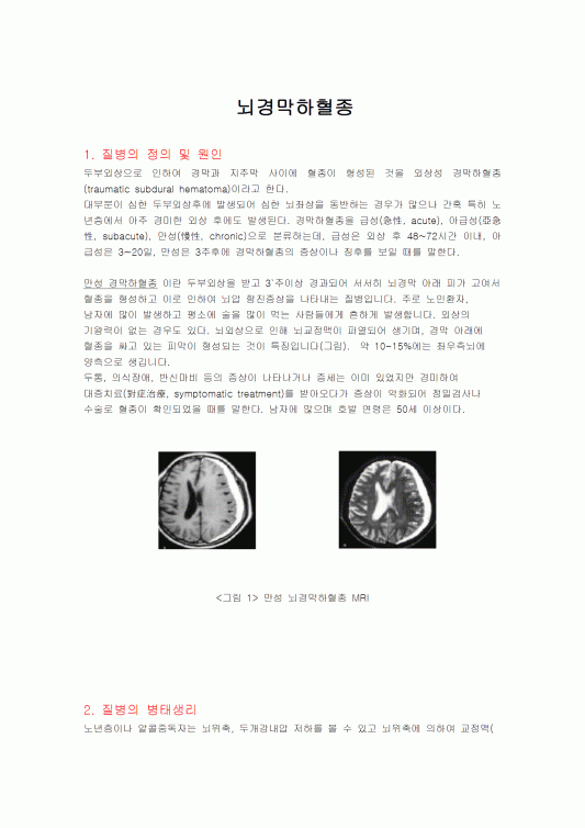 뇌경막하혈종