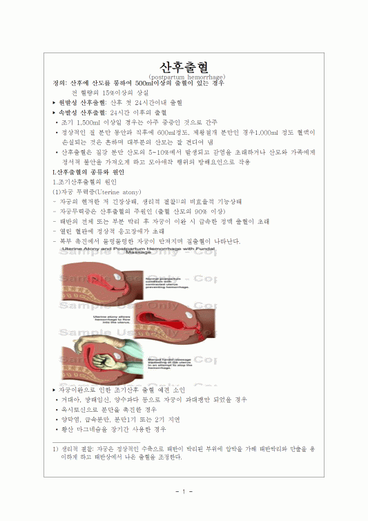 산후출혈에 관해