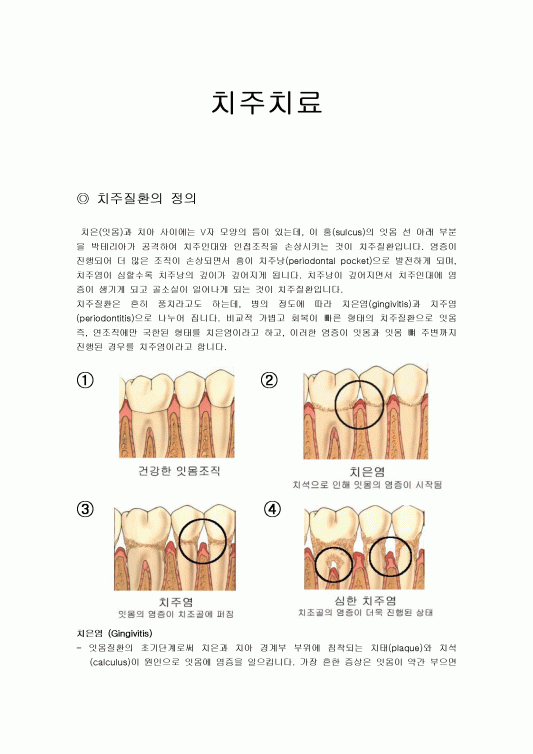 치주질환의 원인과 증상 및 치료방법