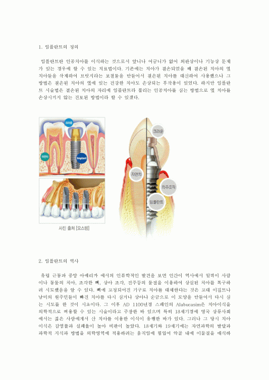 임플란트의 정의와 역사, 종류