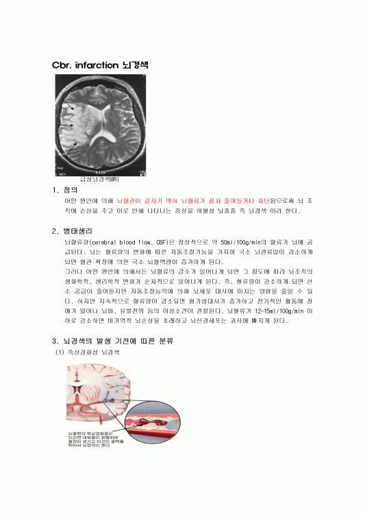 [신경외과] Cbr. infarction 뇌경색 급성뇌경색MRI
