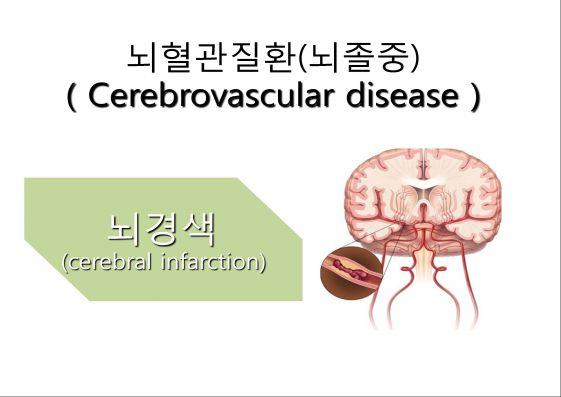 뇌혈관질환(뇌졸중) (Cerebrovascular disease).ppt