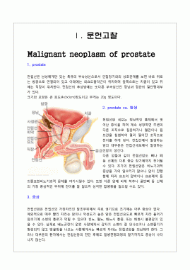 성인간호학 전립선암(Malignant neoplasm of prostate) Case study-2페이지