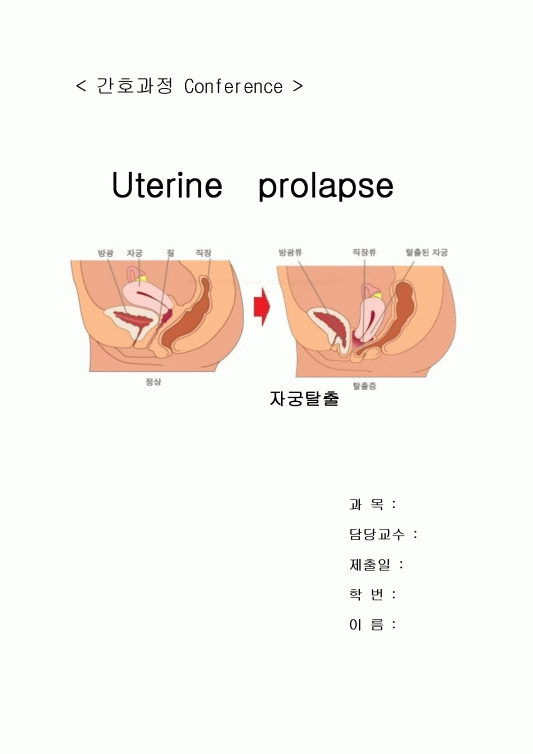 자궁탈출 uterine prolapse 간호진단  간호과정 모성 AA레포트