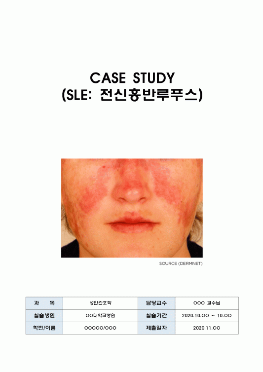 [성인간호학 A+ 자료] SLE 전신홍반루푸스 CASE STUDY (제대로 된 자료를 구매하세요.)