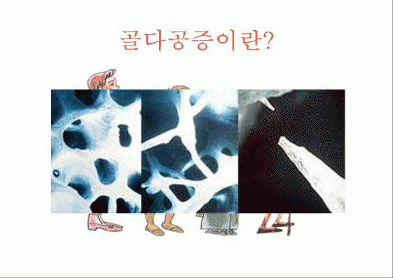 골다공증에 대한 이해와 분석