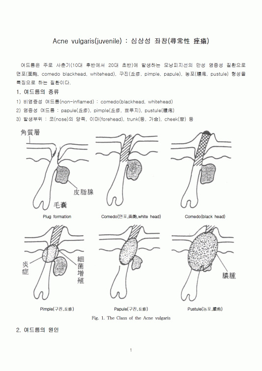 여드름 Acne vulgaris(juvenile) : 심상성 좌창(尋常性 痤瘡)