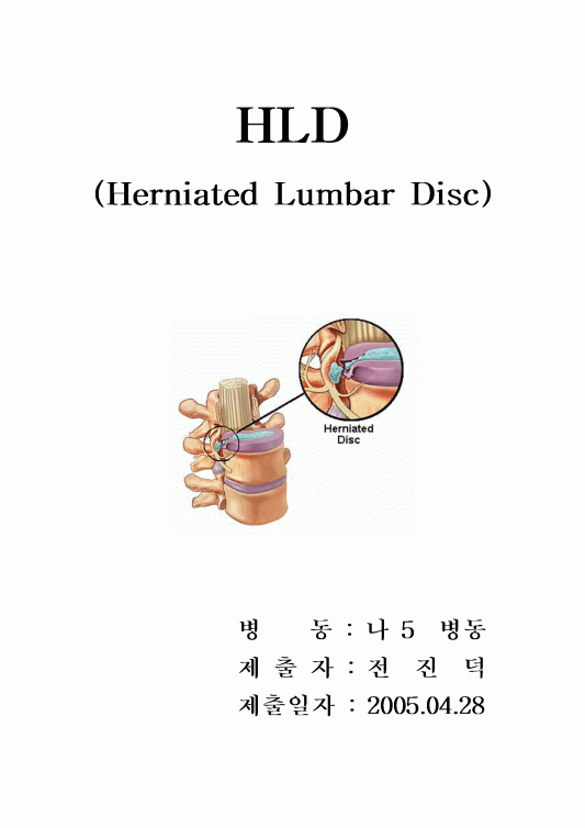 HLD(herniated lumbar disc)