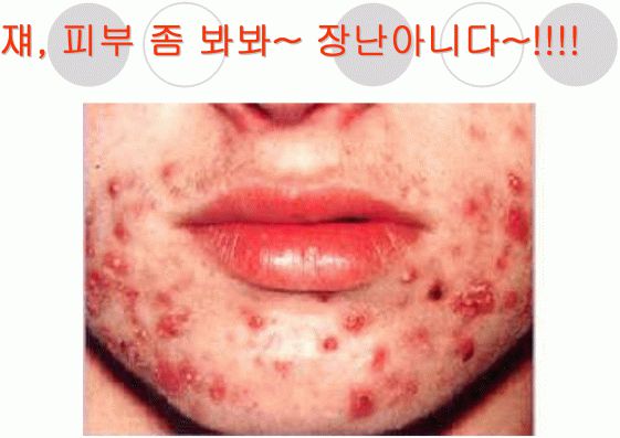 청소년을 대상으로한 여드름 예방 및 치료 교육 발표