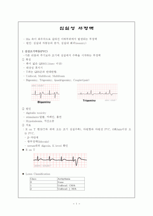 심실성 부정맥