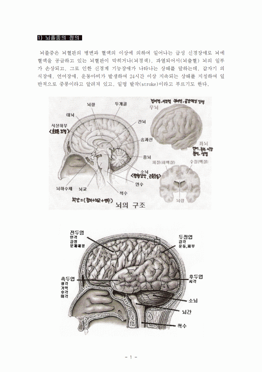 뇌졸중에 관하여