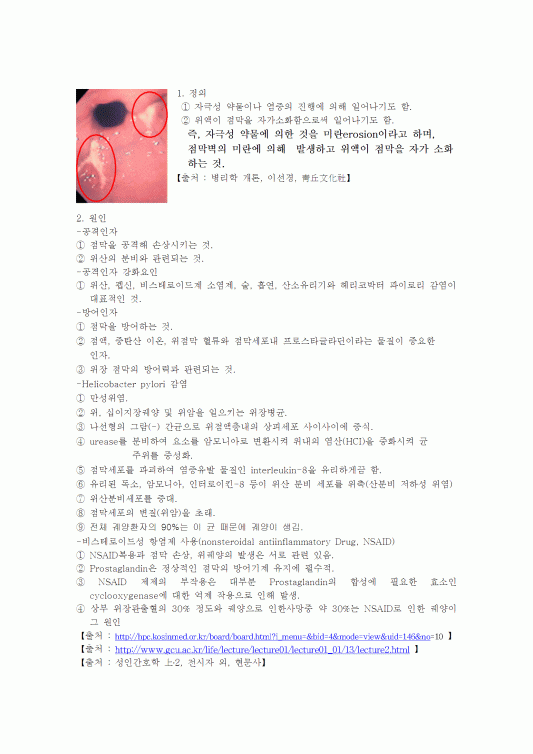 위궤양의 원인과 증상 합병증 및 치료법