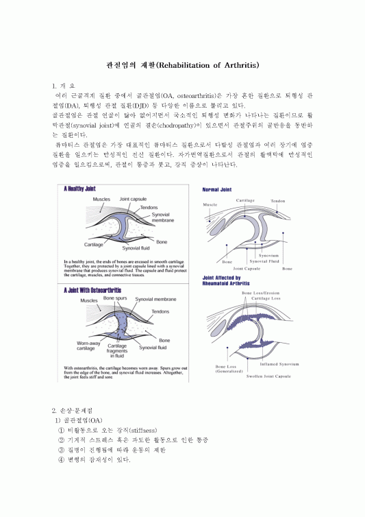 관절염의 재활