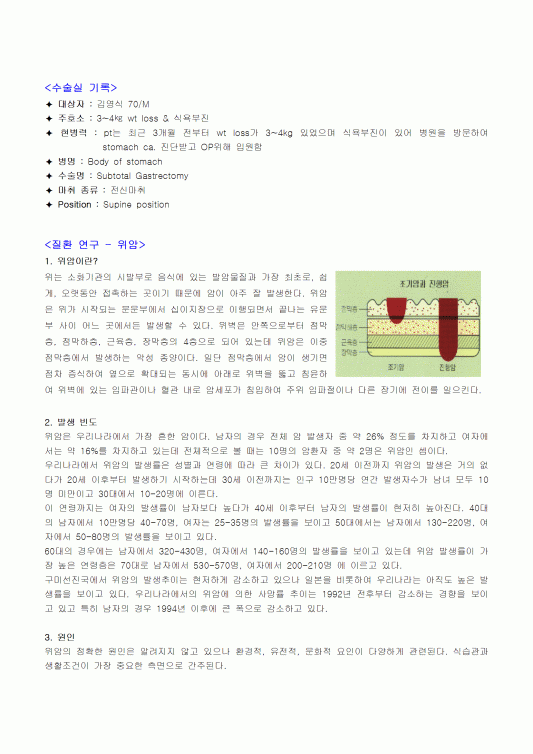 [수술실]Subtotal Gastrectomy case (부분적위절제술)