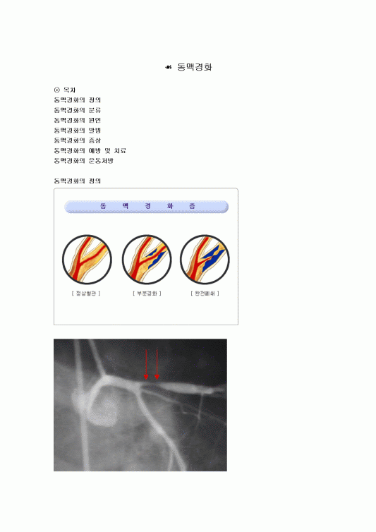동맥경화 레포트 자료