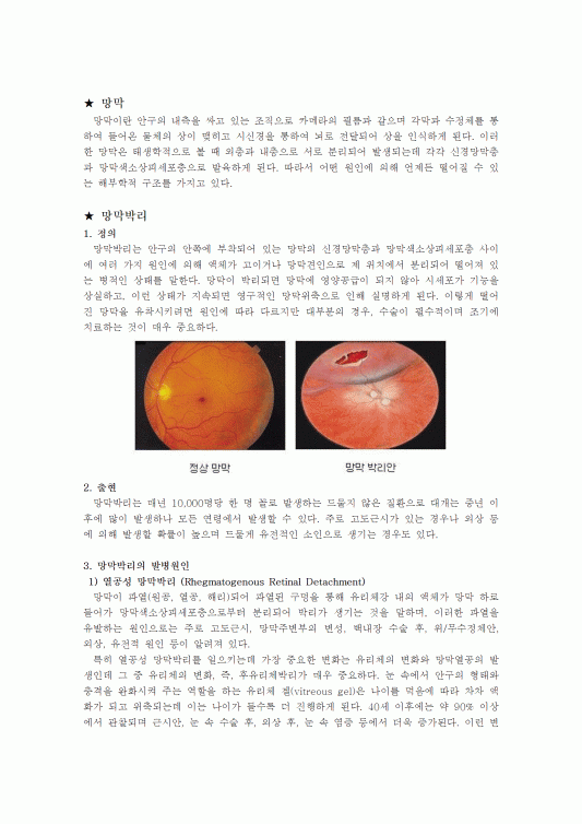 안질환 - 망막박리