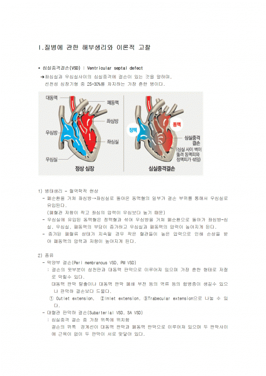 심실 중격 결손