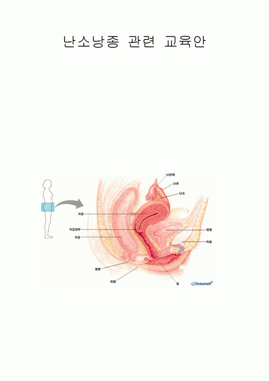 난소낭종 관련 교육안