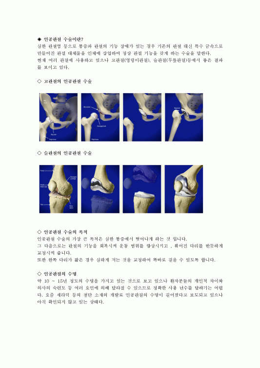 인공 슬관절, 고관절 수술