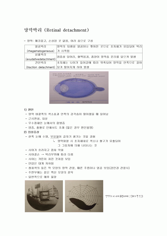 망막박리 레포트 자료