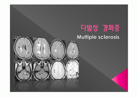 다발성 경화증