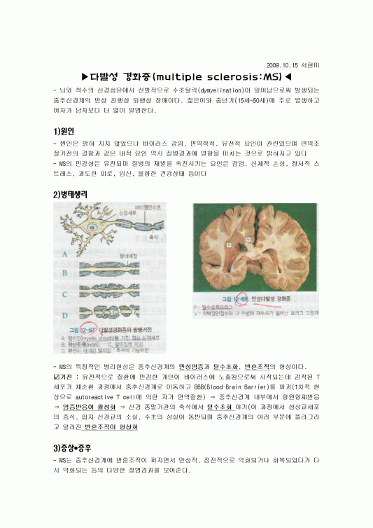 다발성경화증(MS)
