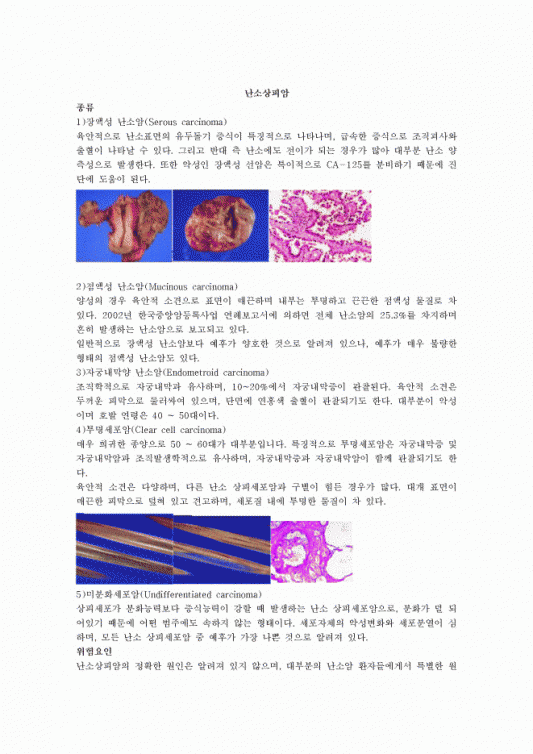 난소 악성 종양