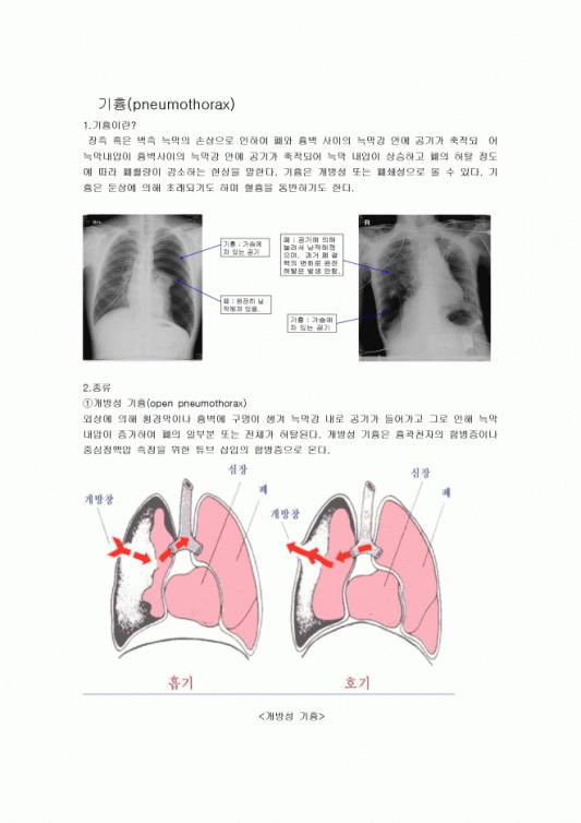 기흉 문헌고찰