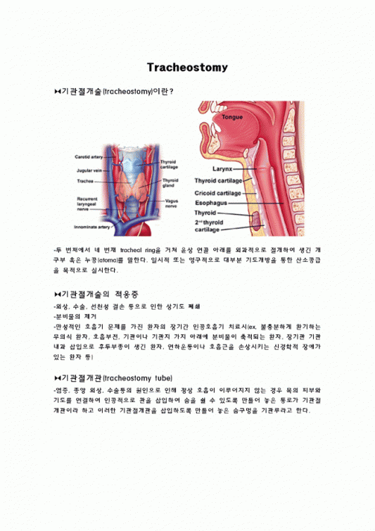 [논문] Tracheostomy