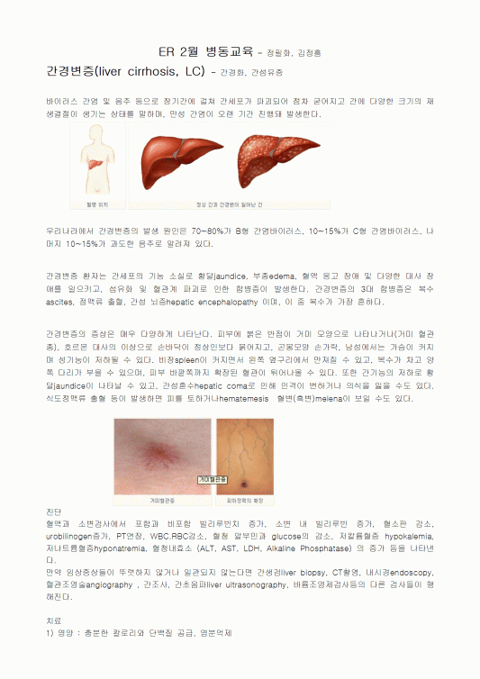 간경변증, 간성혼수