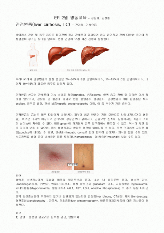 간경변증에대해서
