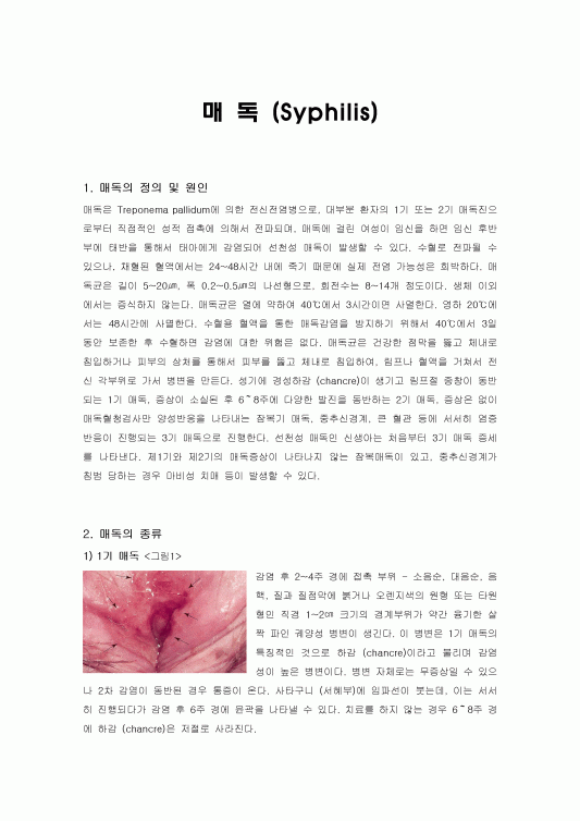 매 독 (Syphilis)