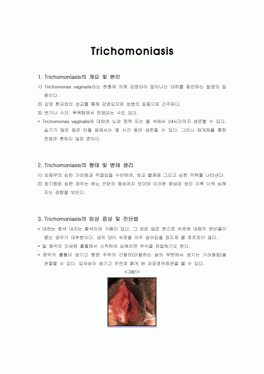 트리코모나스증 (질염) Trichomoniasis