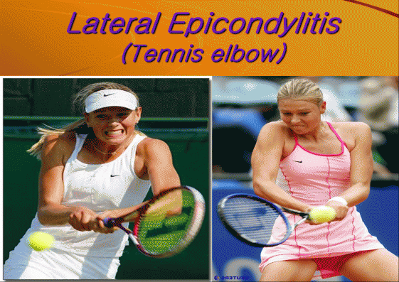 tennis elbow(외측상과염)