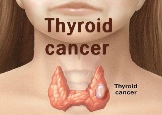Thyroid cancer case study