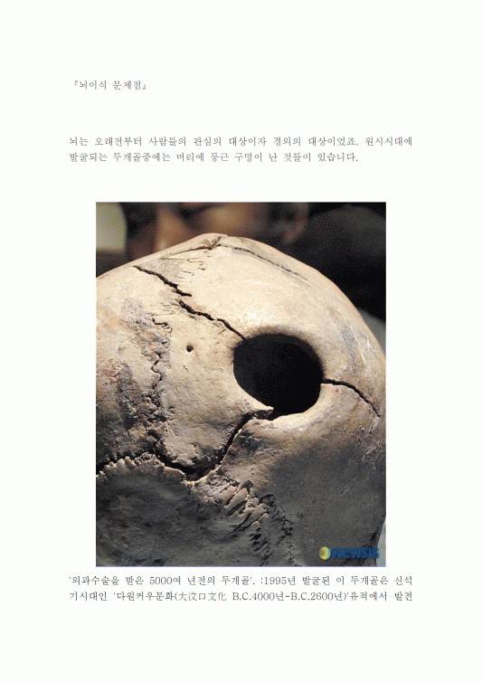 뇌이식 문제점