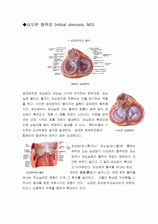 성인간호학 - 승모판협착증 문헌고찰