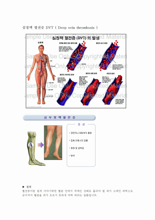 심정맥 혈전증 DVT