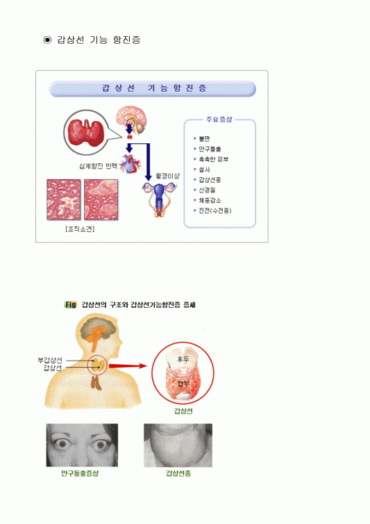 갑상선 기능 항진증
