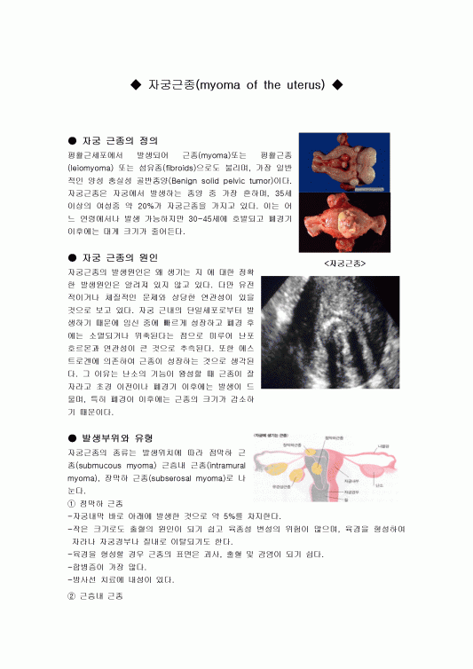 자궁근종 문헌고찰
