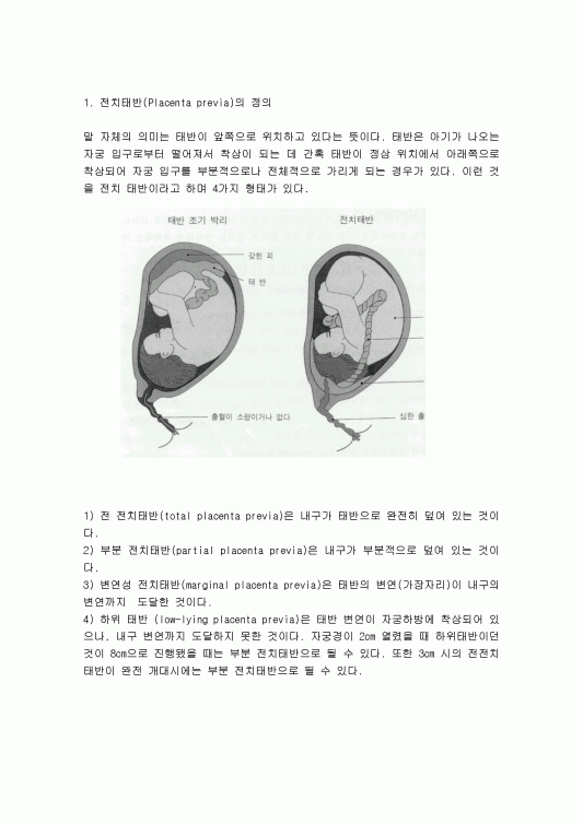 전치태반_문헌고찰