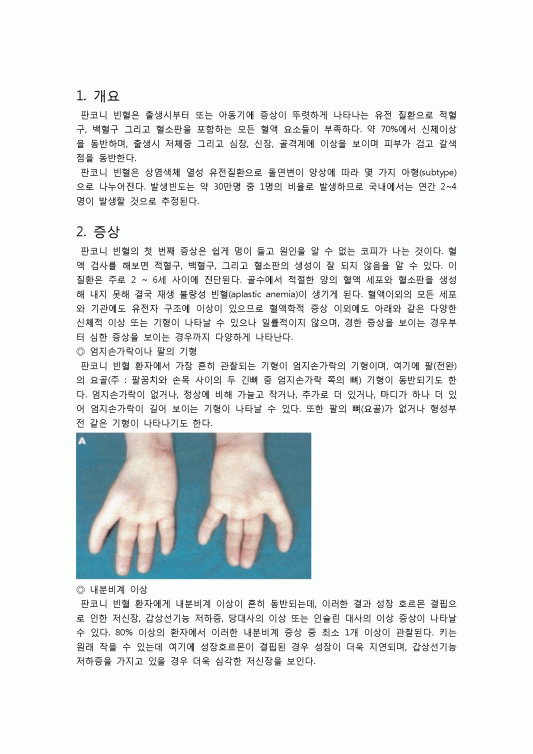 판코니 빈혈 레포트 자료