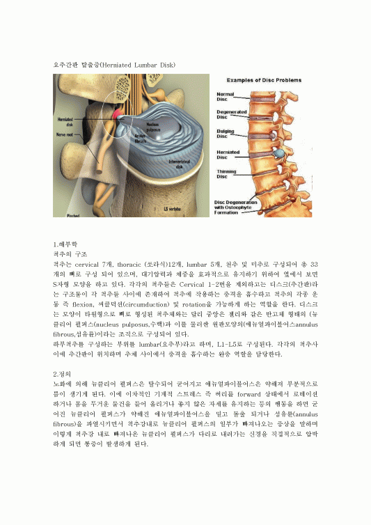 스포츠 선수의 추간판 탈출증의 이해 및 손상,치료,재활