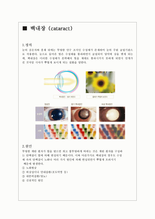 백내장과 녹내장