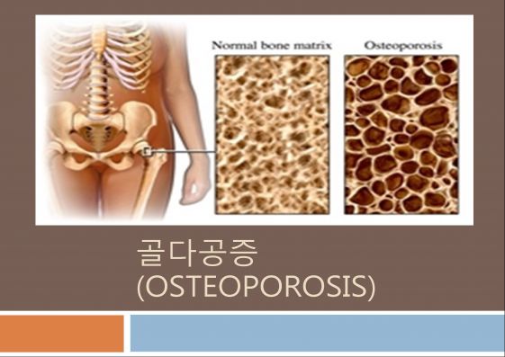 골다공증. (Osteoporosis)