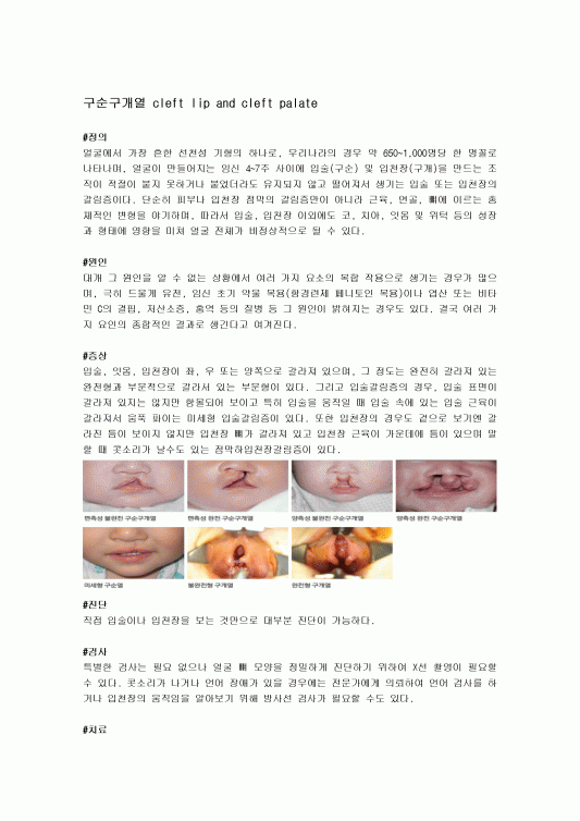 구순구개열 cleft lip and cleft palate 케이스
