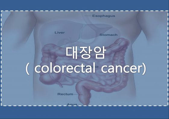 대장암, 대장내시경, 대장암치료20130524